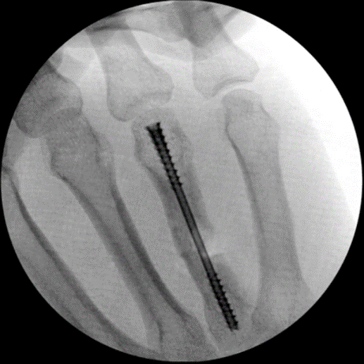 Case Reports: NX Nail and Microscrew | Hand Fracture Management